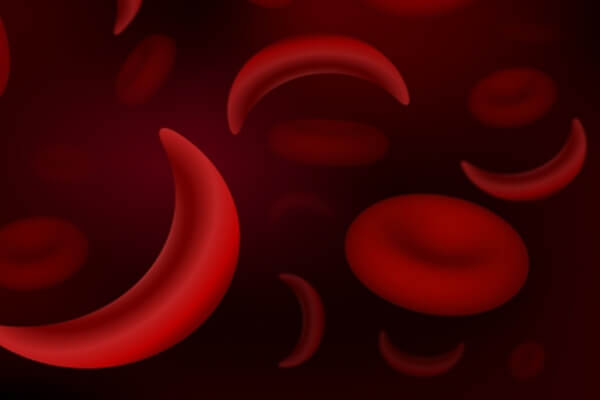 Doença falciforme: você já ouviu falar sobre? - Hospital Sagrada Familia.